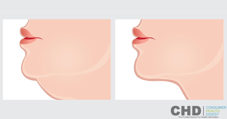 Sagging Chin - Facts, Causes, Signs and Symptoms, Treatments and More