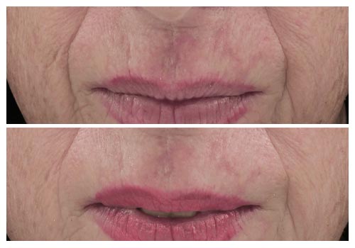 Needleless Serum Before And After