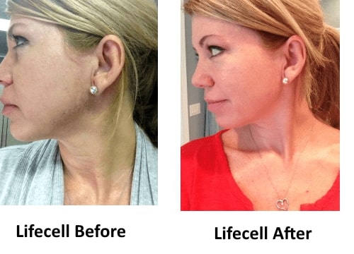 Lifecell Reviews Does Lifecell Anti Aging Cream Work