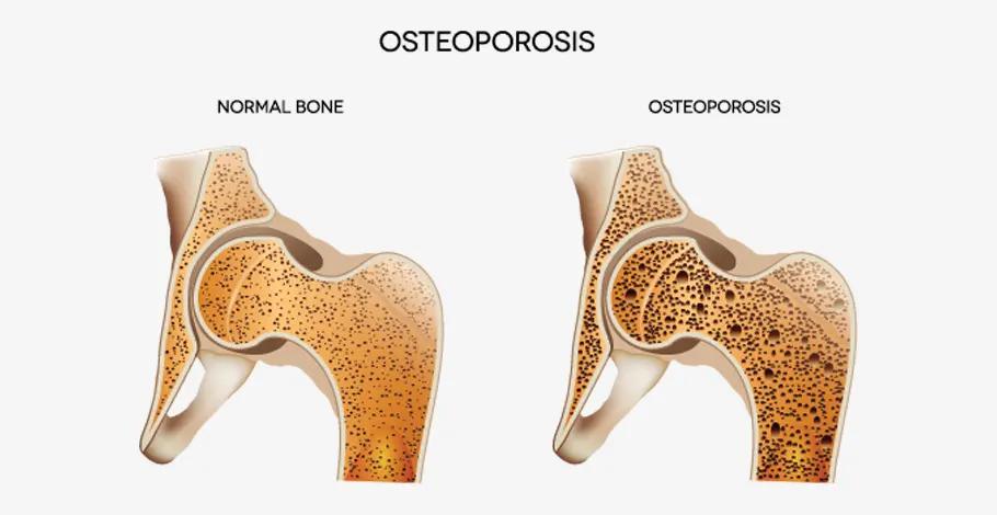 Learn About Osteoporosis, (Causes, Symptoms & Treatment)