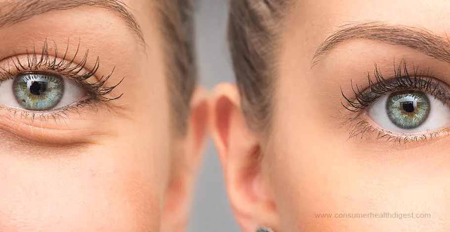 How to Remove Under Eye Bags - Diagnosis and Treatment